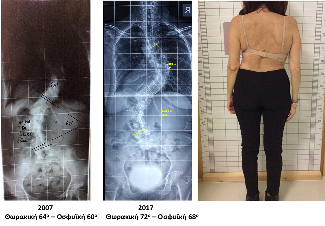 Σκολίωση ενηλίκων - Schroth Scoliosis & Spine Clinic