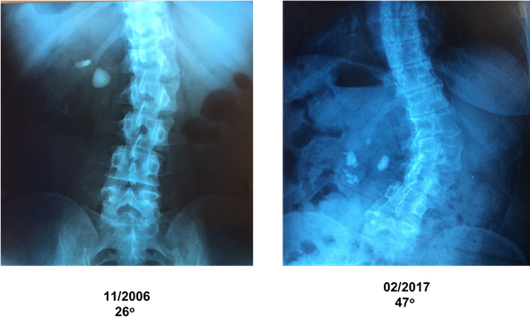 Σκολίωση ενηλίκων - Schroth Scoliosis & Spine Clinic