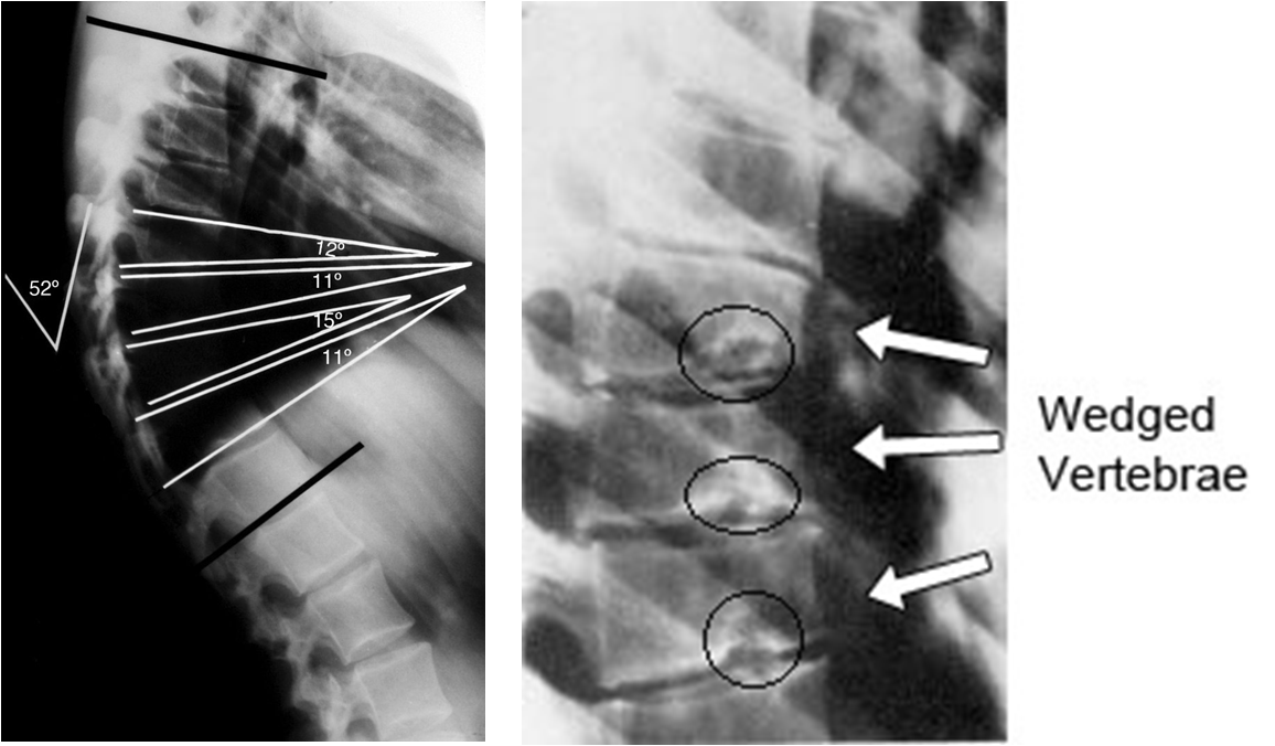 Κηδεμόνες για Κύφωση / Schroth Scoliosis & Spine Clinic