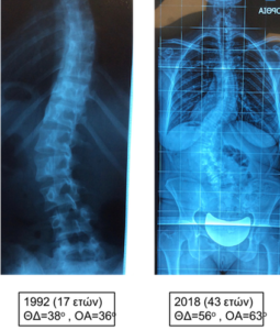 Σκολίωση ενηλίκων - Schroth Scoliosis Spine Clinic