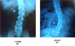 Σκολίωση ενηλίκων - Schroth Scoliosis Spine Clinic