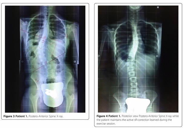 Σχετικά με την μέθοδο SEAS - Schroth Scoliosis Spine Clinic